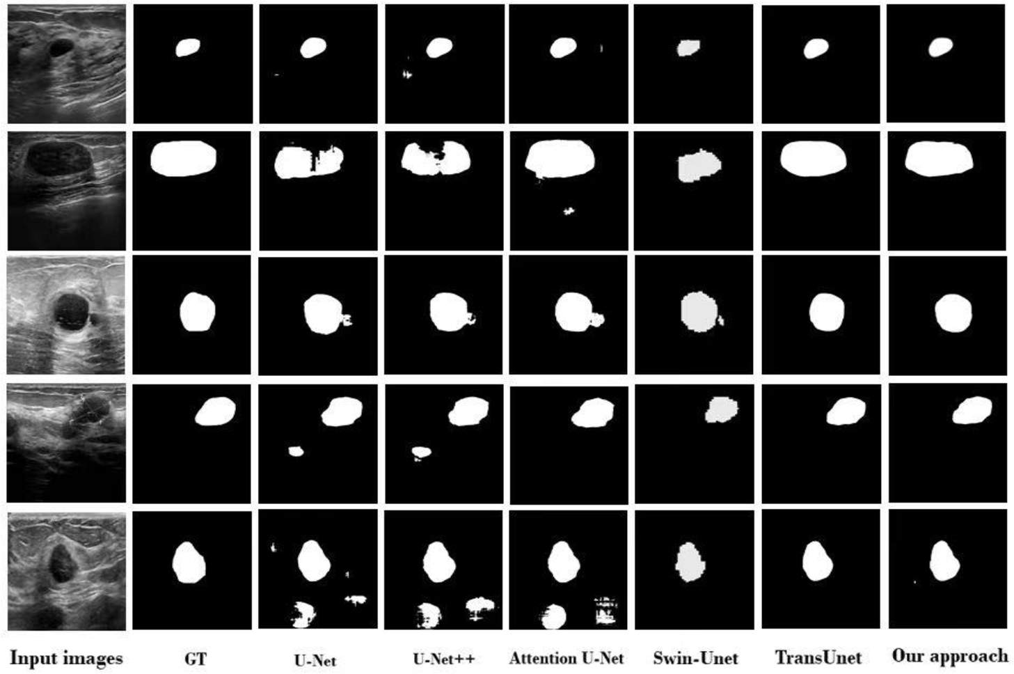 D-TransUNet: A Breast Tumor Ultrasound Image Segmentation Model Based ...